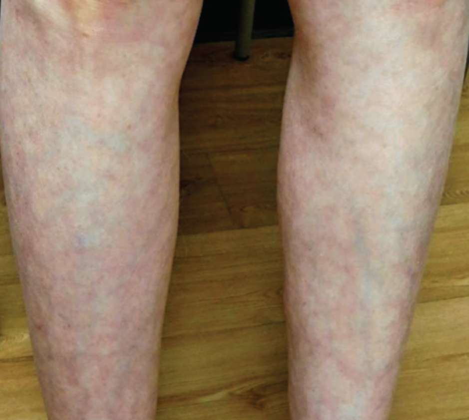 COVID Rashes - LP - Walk-in Dermatology 2